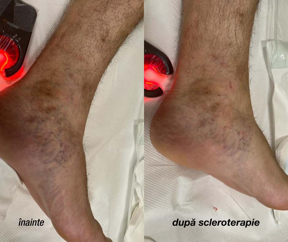 Dr. Toni Feodor: De ce bărbații fac boala varicoasă mai severă decât ...